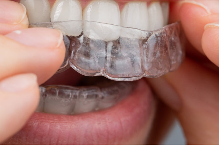 Clear Aligners: Tips for a Perfect Fit